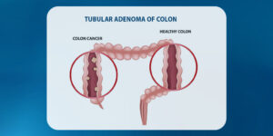 Tubular Adenoma of Colon: Causes, Symptoms & Diagnosis