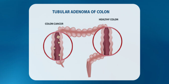 Tubular Adenoma of Colon: Causes, Symptoms & Diagnosis