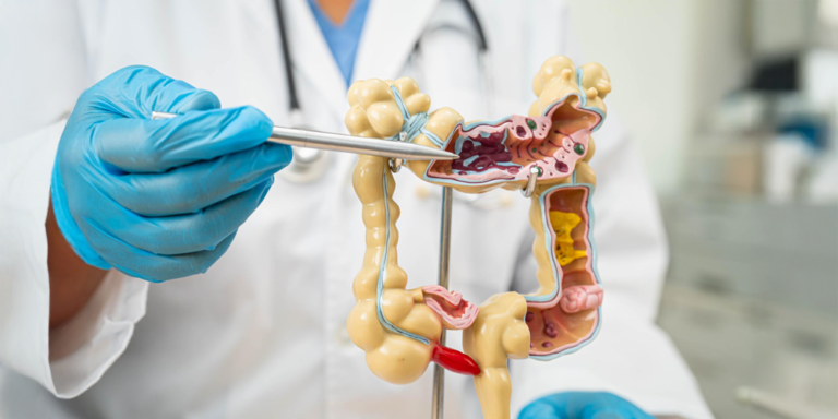 Tubular Adenoma of Colon: Causes, Symptoms & Diagnosis