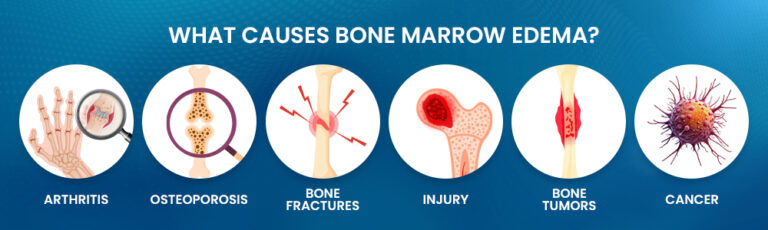Bone Marrow Edema: Causes, Symptoms and Treatment Options