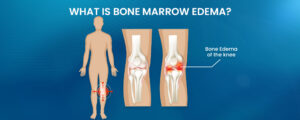 Bone Marrow Edema: Causes, Symptoms and Treatment Options