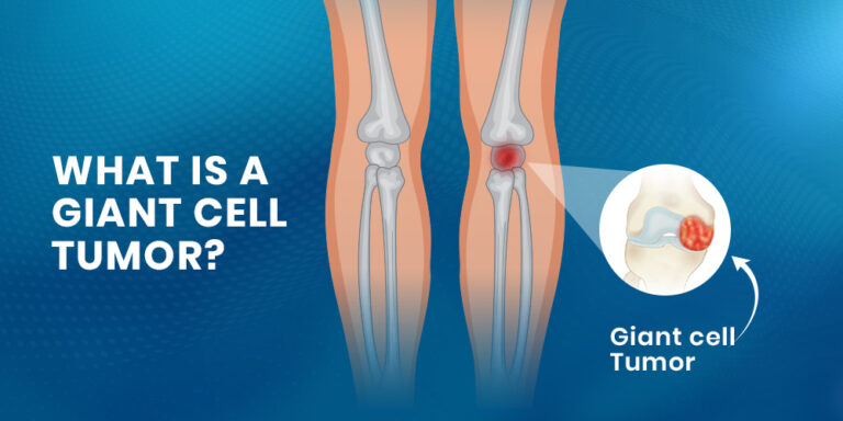 Understanding Giant Cell Tumors: Symptoms, Causes & Diagnosis