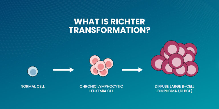Richter's Syndrome in CLL: Transformation Explained