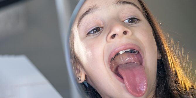 Palate Cancer (Roof of the Mouth): Causes, Symptoms & Care