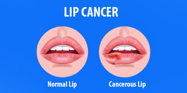 Lip Cancer: Causes, Symptoms, Diagnosis & Treatment Options