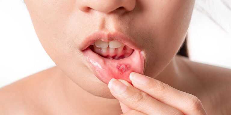 Lip Cancer: Causes, Symptoms, Diagnosis & Treatment Options